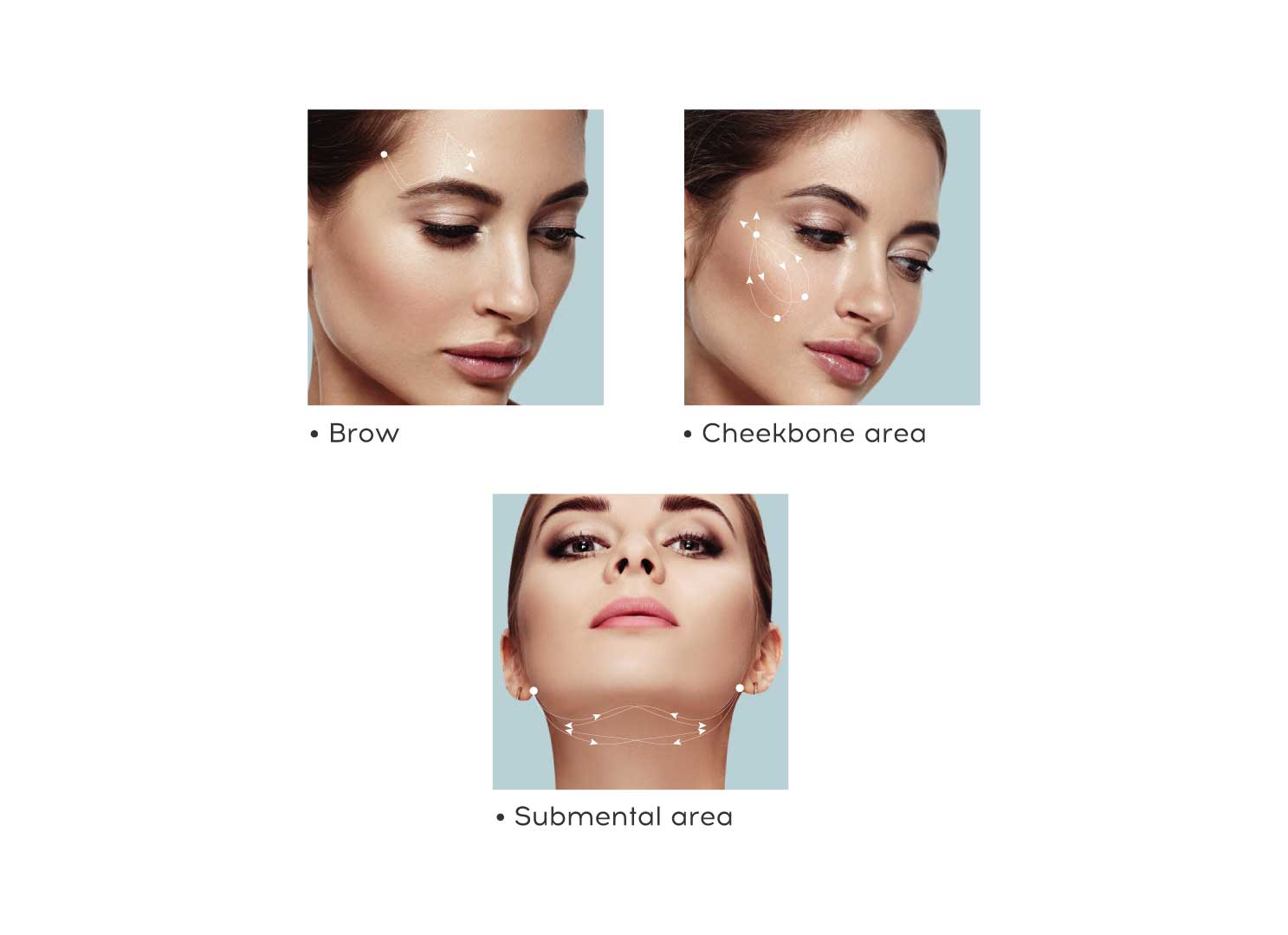 Aptos Light Lift - Needle Method | Medica